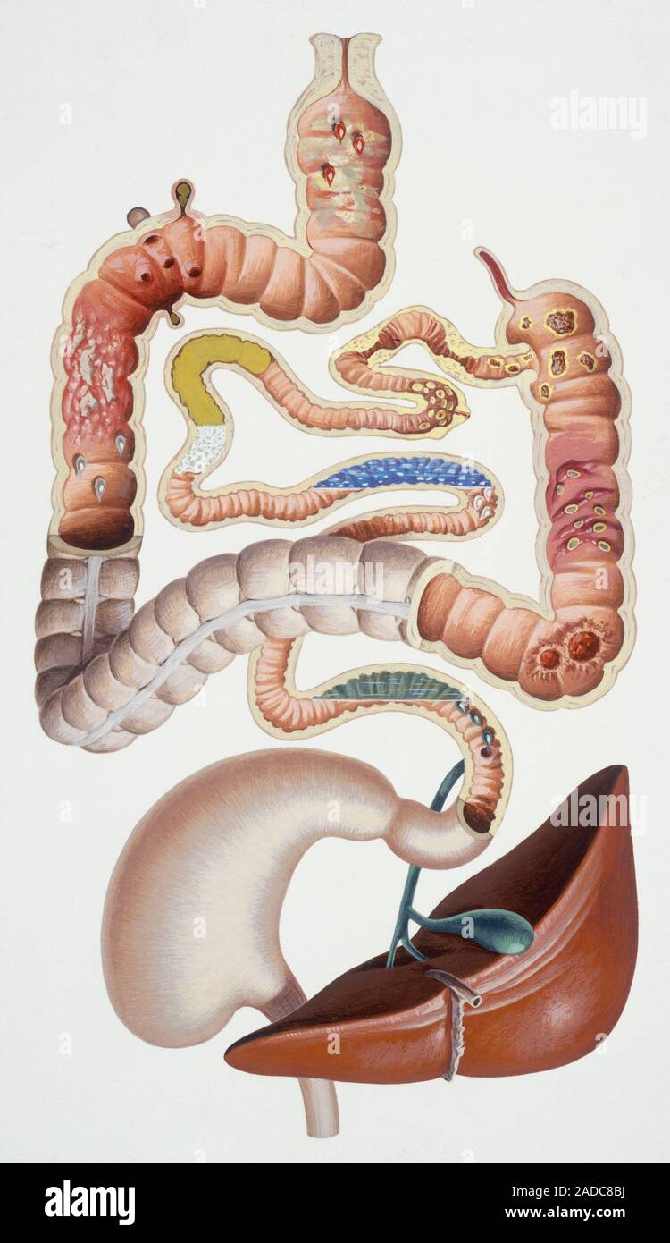 Diarrhoea, its causes and results, illustration Stock Photo - Alamy