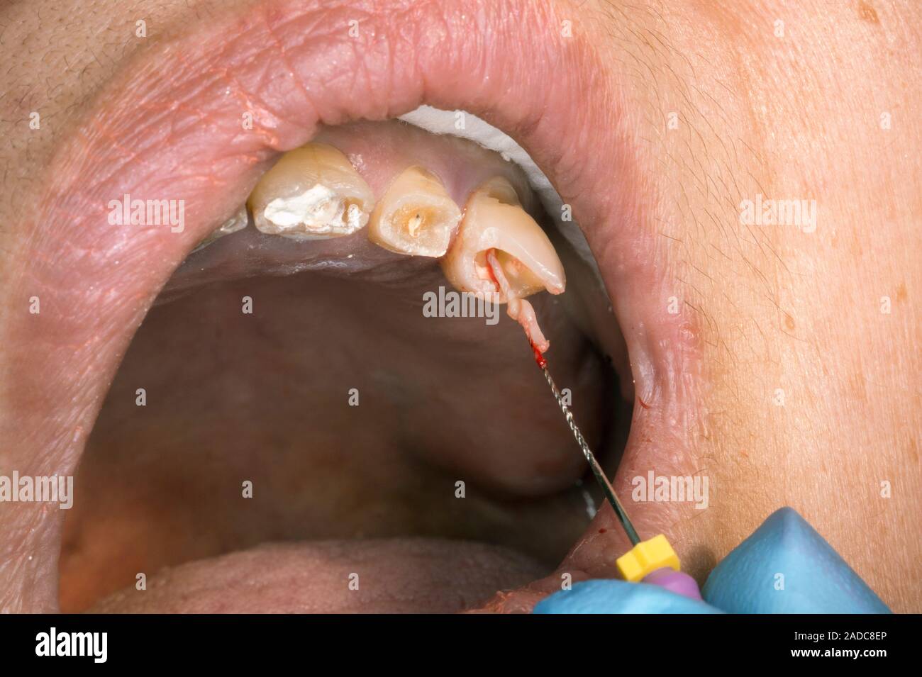 Root canal surgery. Close-up of dental tools being used to extract ...