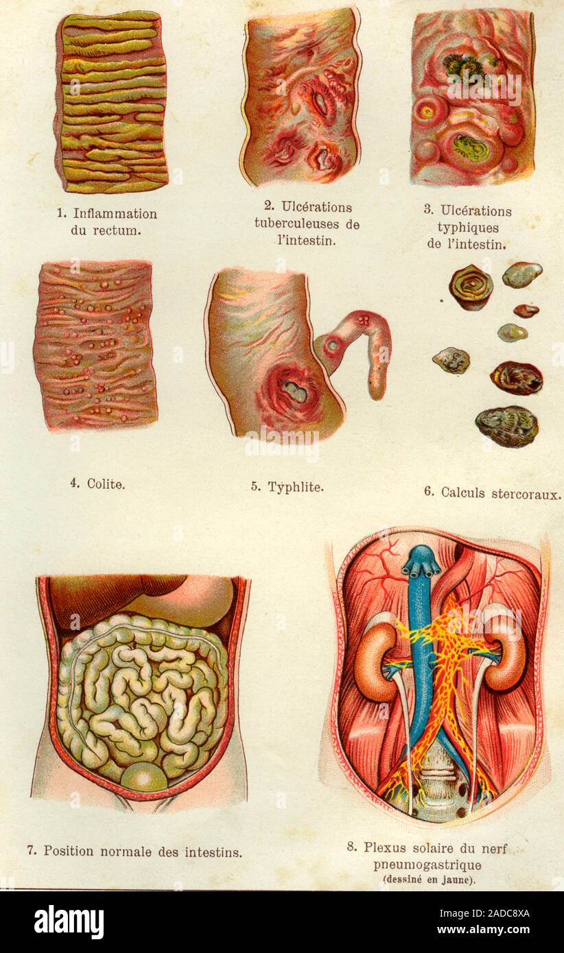 Intestine and kidney diseases. 1898 French illustration showing the ...