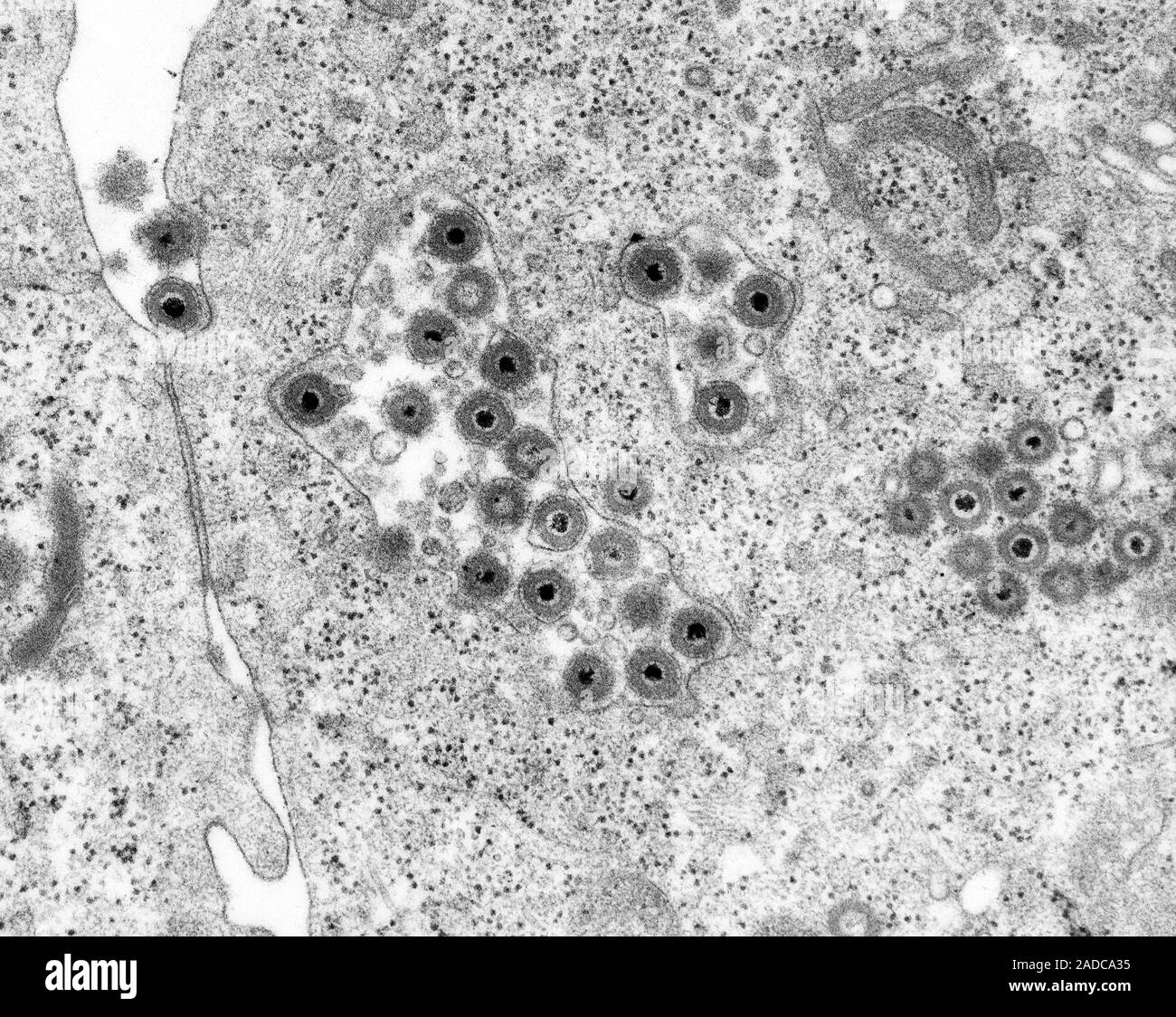 Herpes simplex virus (HSV-2, DNA virus) in cellular vacuoles and ...