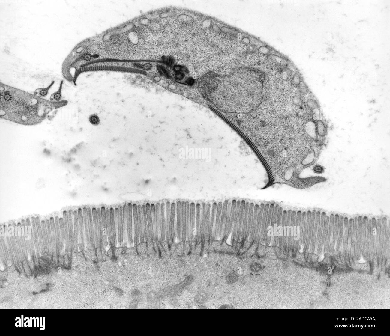 Protozoan infection (giardiasis) in human intestinal lumen (Giardia sp ...