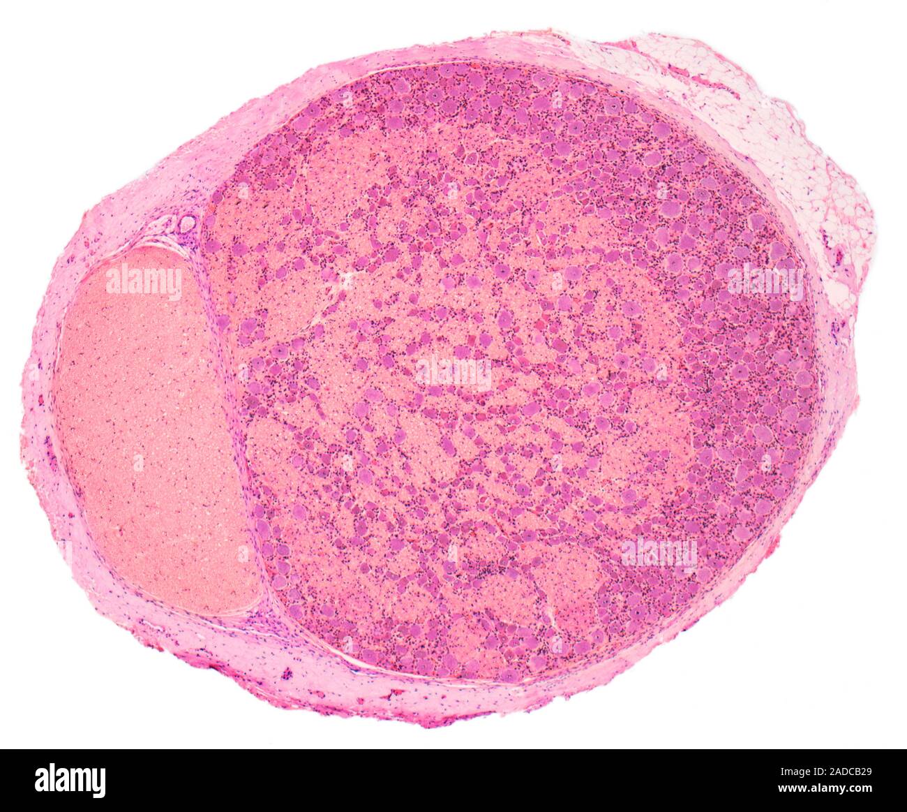 Spinal nerve ganglion. Coloured light micrograph of a section through a ...