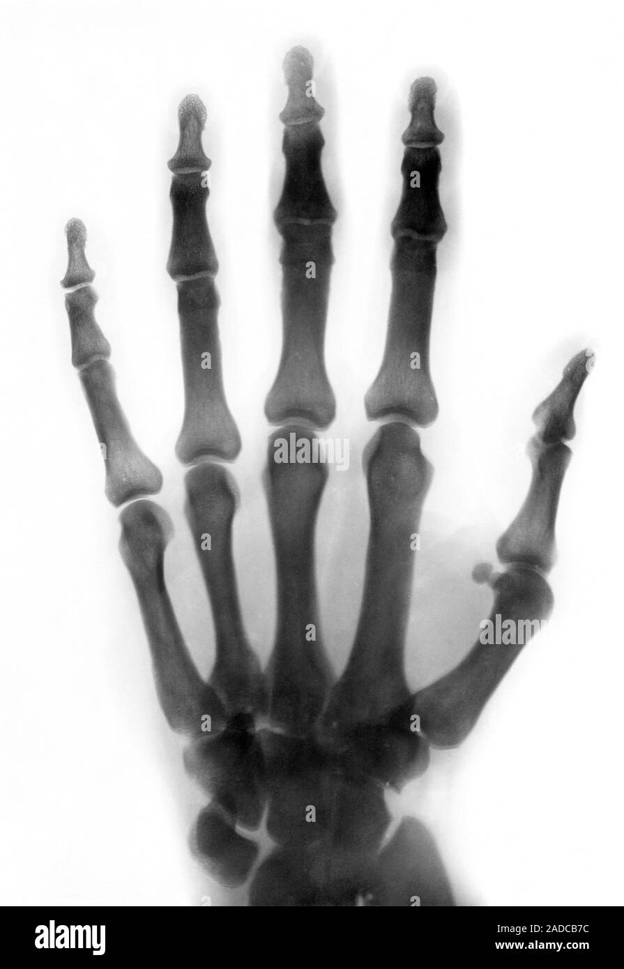 Hand X-ray, dating from 1896. This X-ray was produced by Serb-US ...
