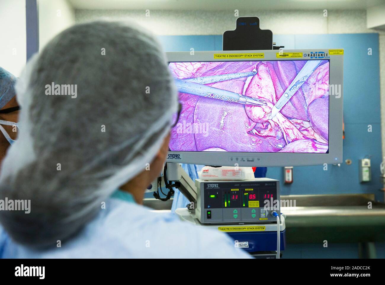 Gall bladder removal surgery. Surgeons carrying out laparascopic gall ...