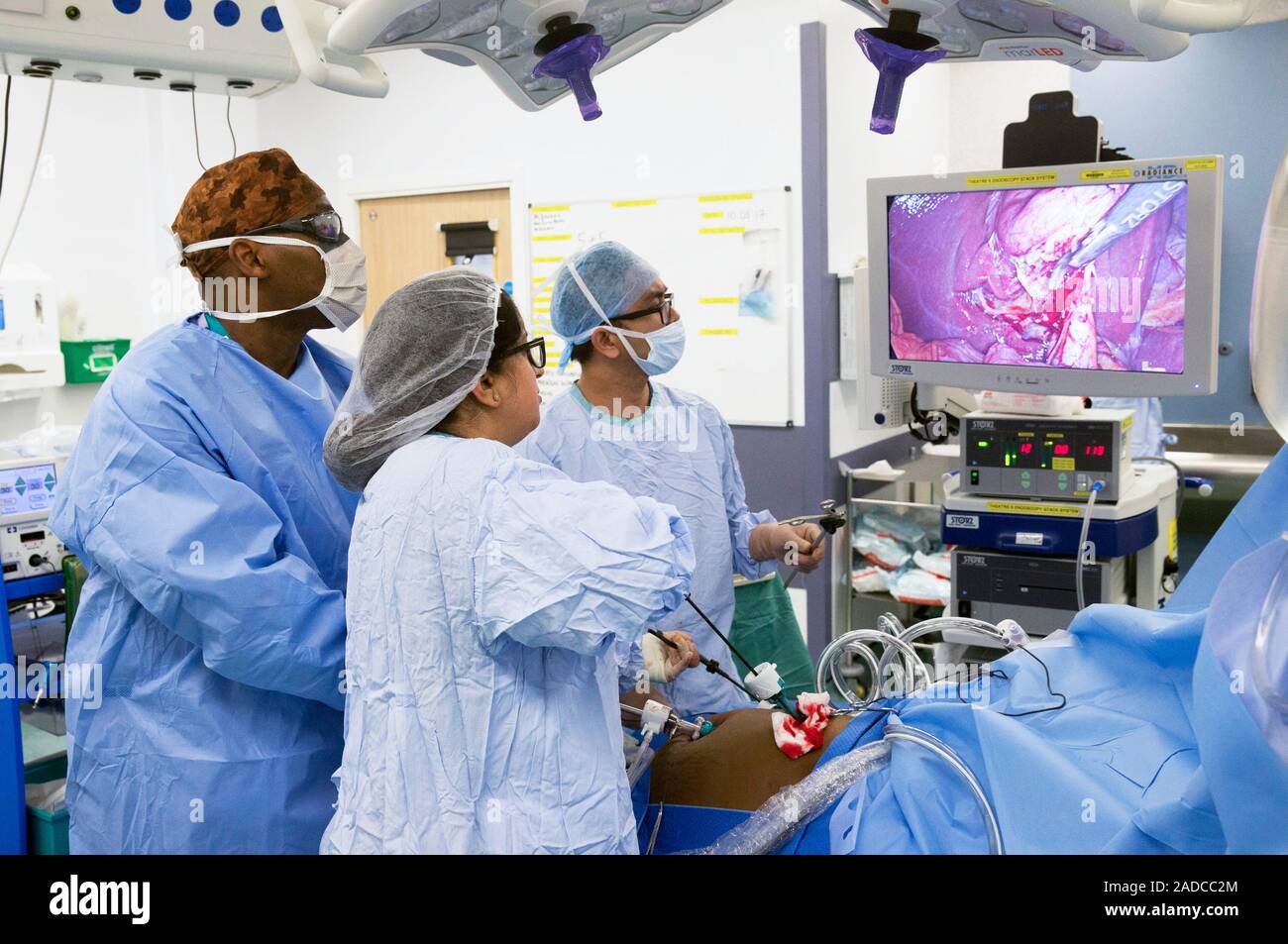 Gall bladder removal surgery. Surgeons carrying out laparascopic gall ...