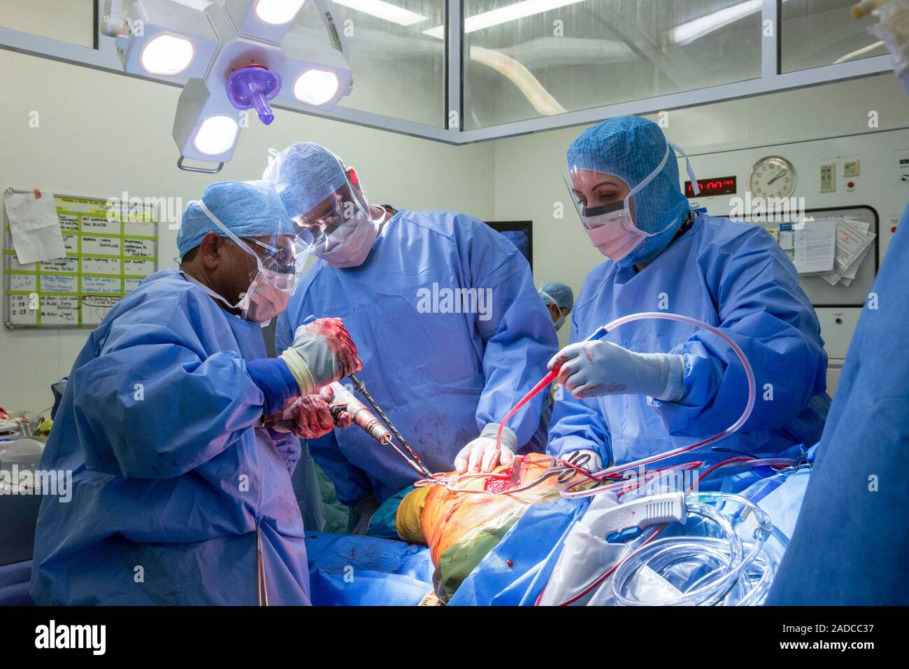 Hip replacement surgery. Surgical team carrying out surgery to replace ...