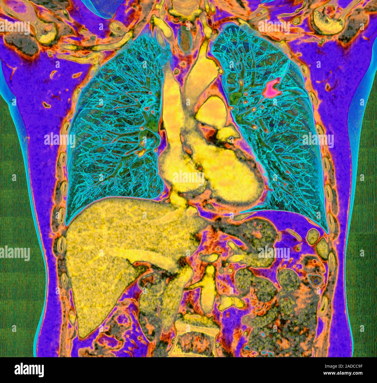 Lung cancer, 3D coloured computed tomography (CT) scan. The lungs ...
