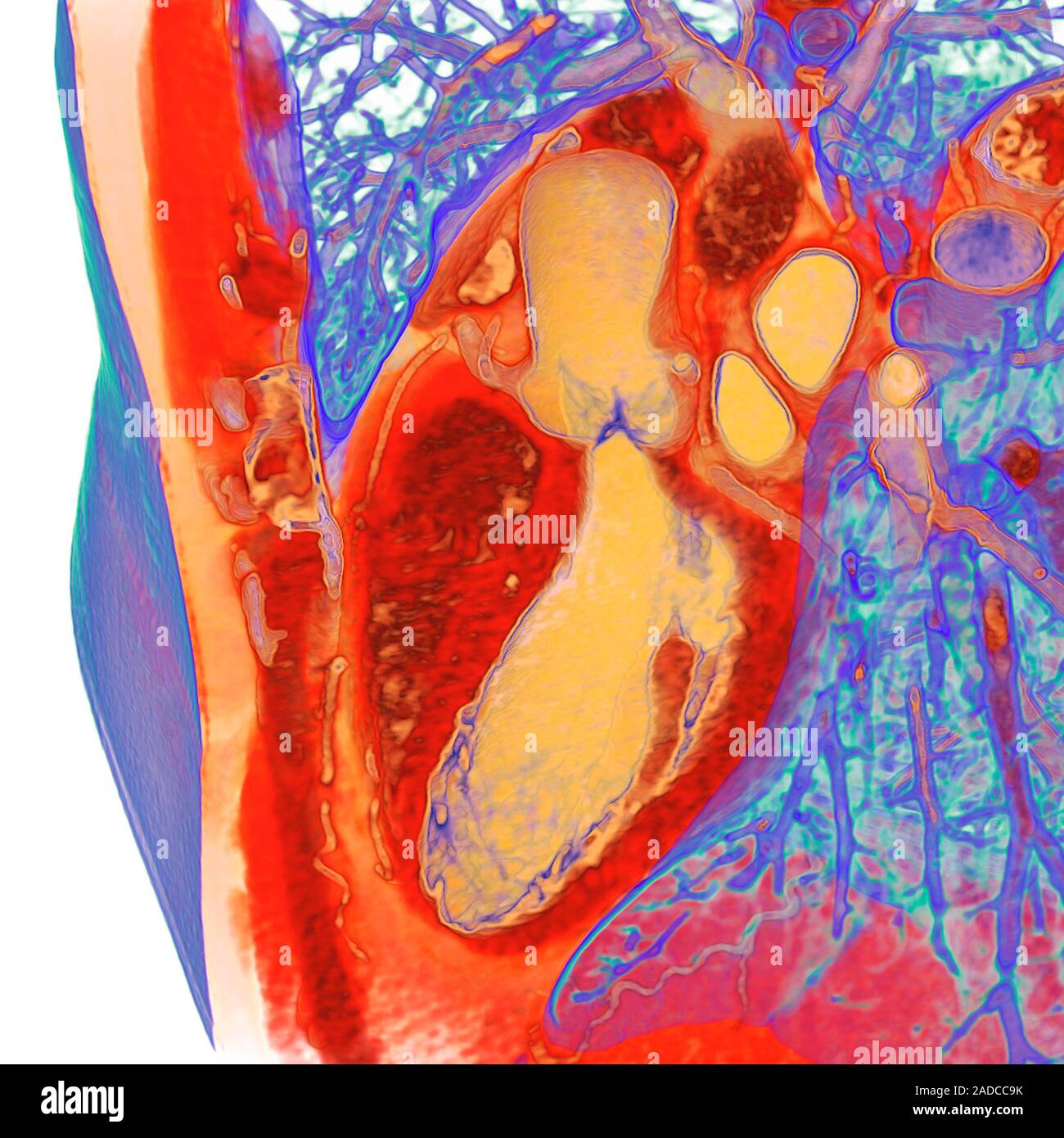 Heart and left ventricle, 3D coloured computed tomography (CT) scan ...
