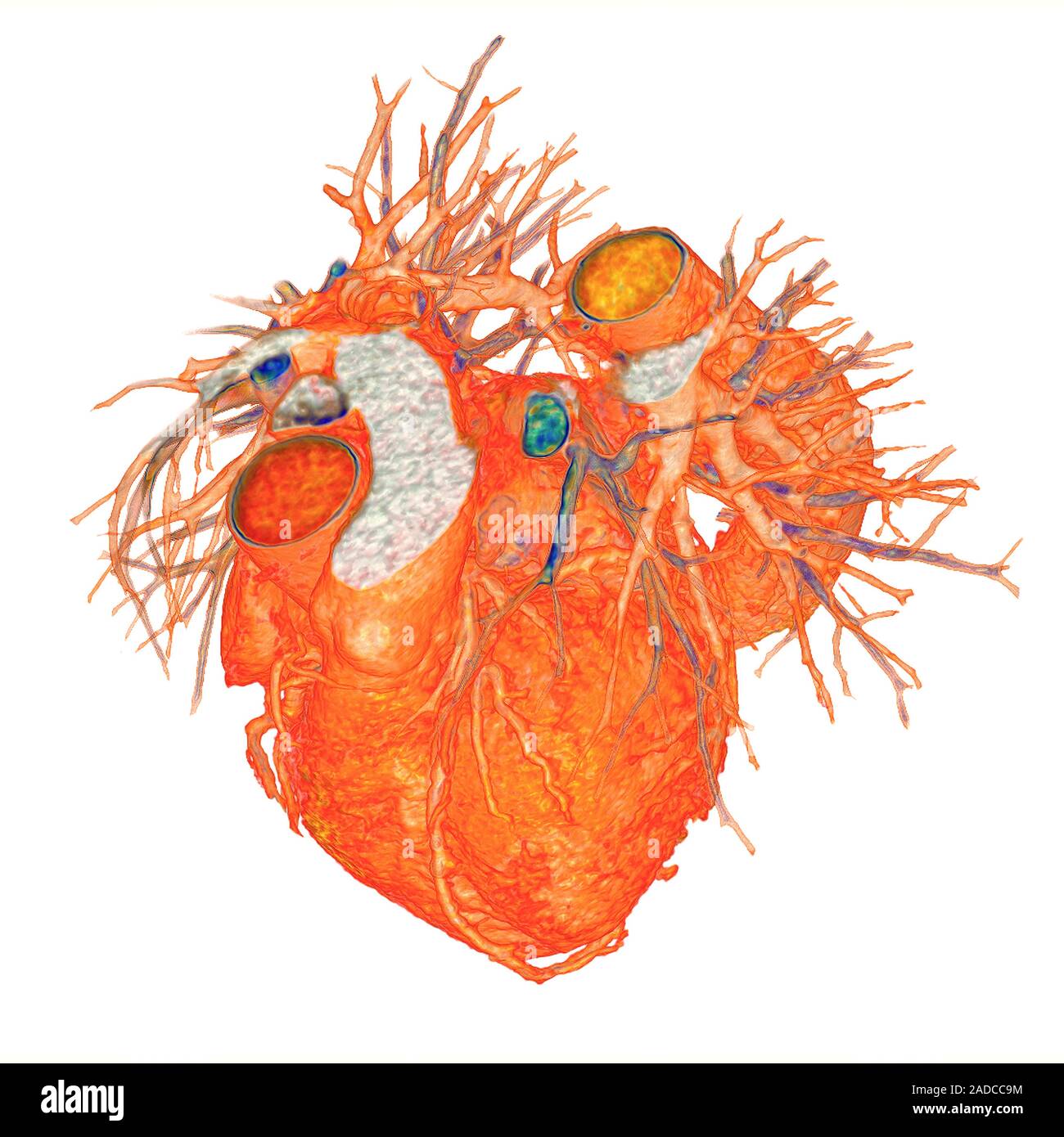 Heart with coronary artery disease, 3D coloured computed tomography (CT ...