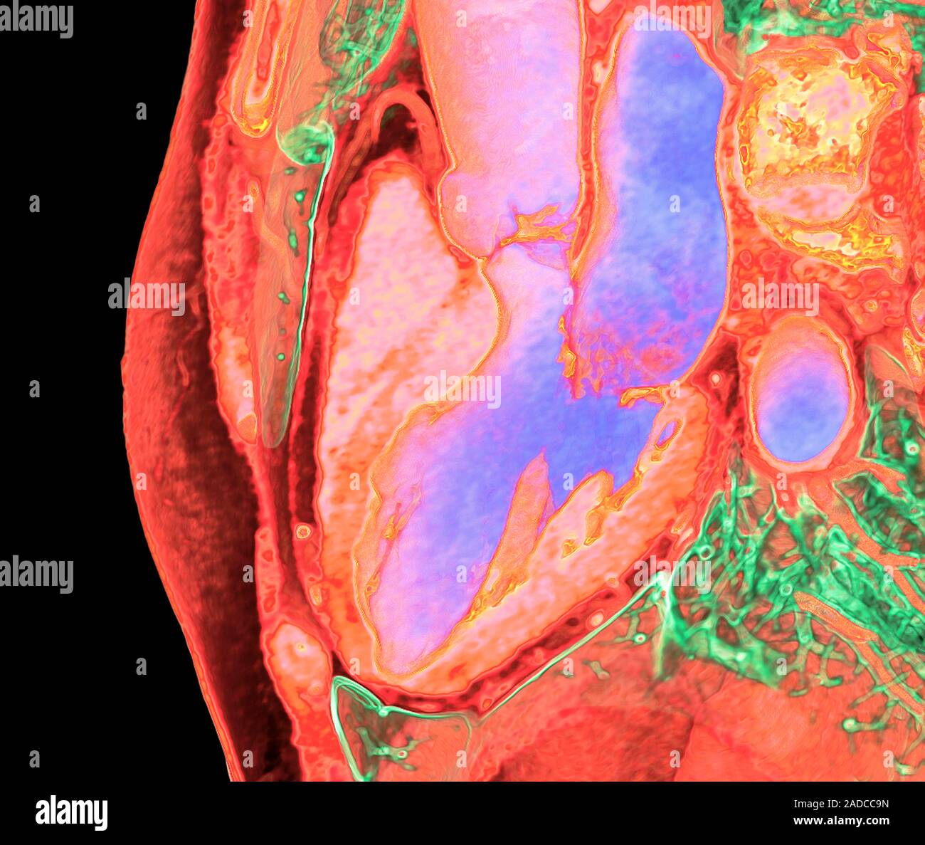 Heart and left-hand chambers, 3D coloured computed tomography (CT) scan ...