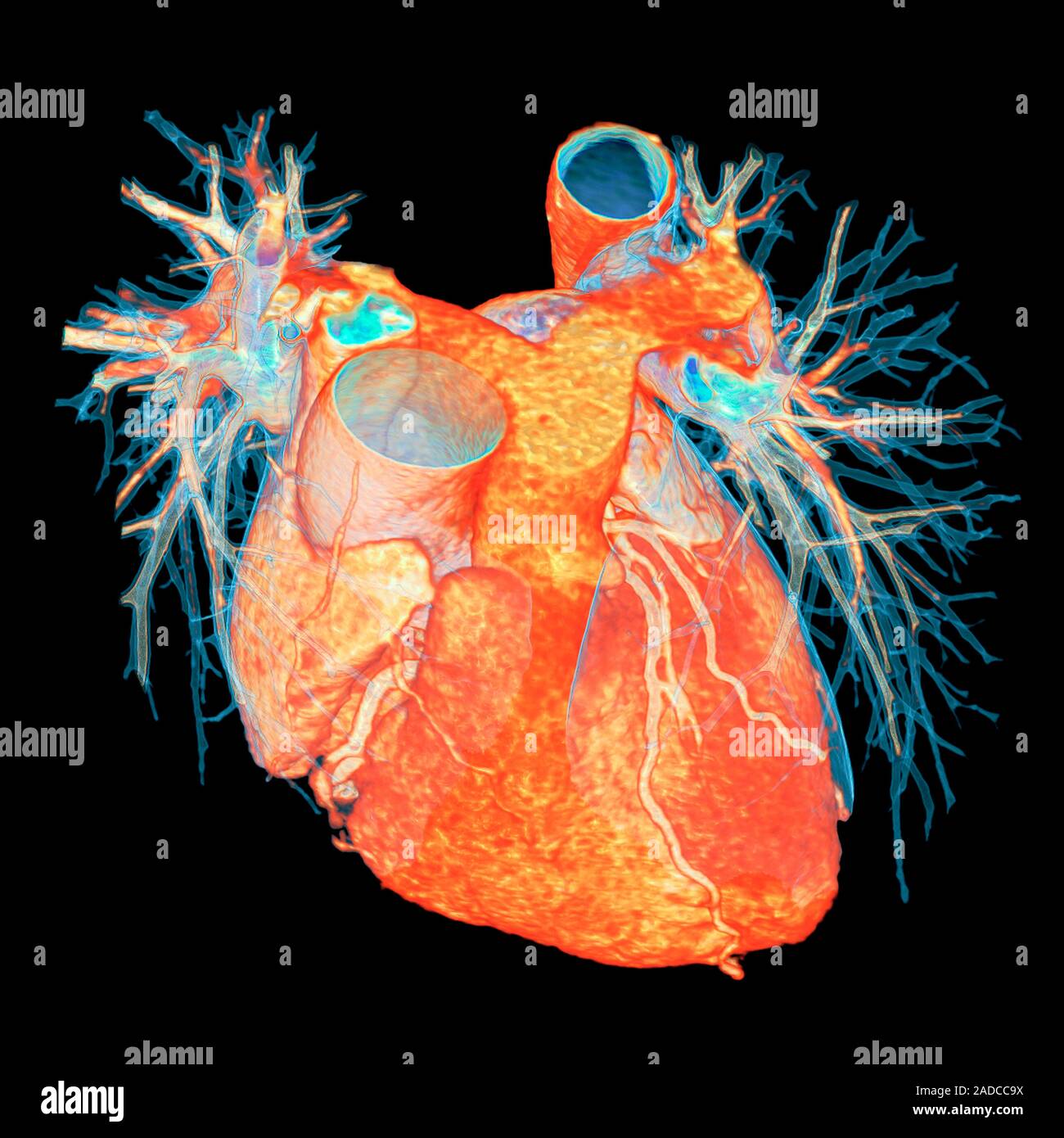 Human heart, 3D coloured computed tomography (CT) scan. The heart is a ...