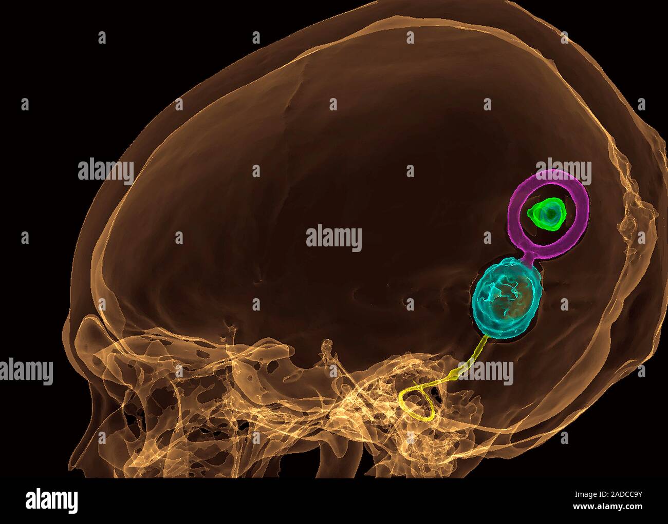 Cochlear implant, 3D coloured computed tomography (CT) scan. This ...