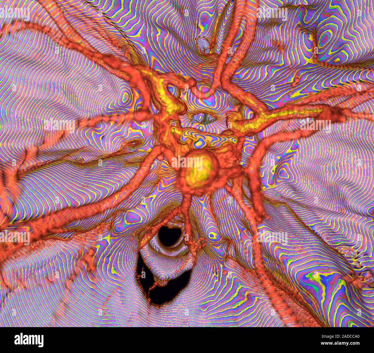 Cerebral aneurysm. 3D coloured computed tomography (CT) scan of an aneurysm (centre) in one of ...