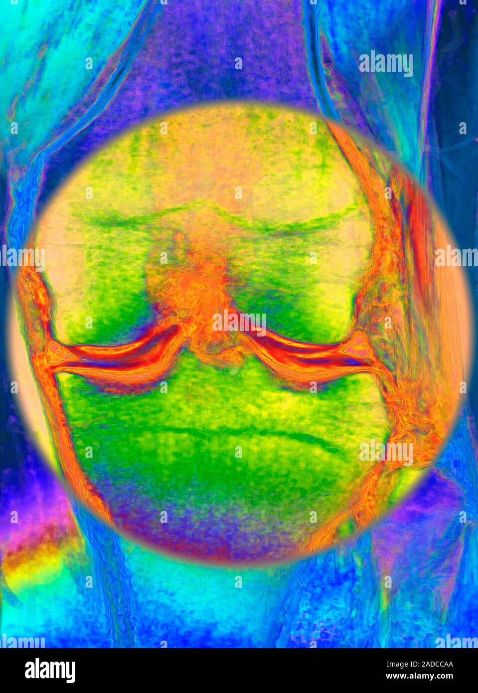 Human knee, 3D coloured magnetic resonance imaging (MRI) scan. This ...