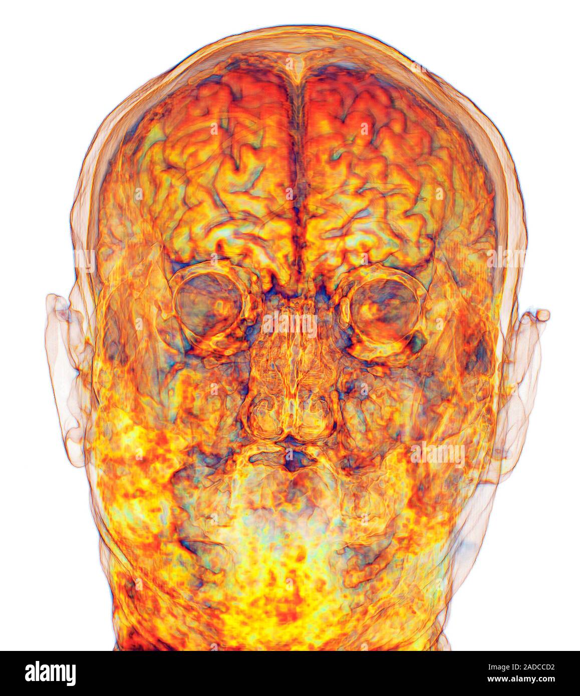 Human head and brain, coloured 3D magnetic resonance imaging (MRI) scan. This frontal coronal ...