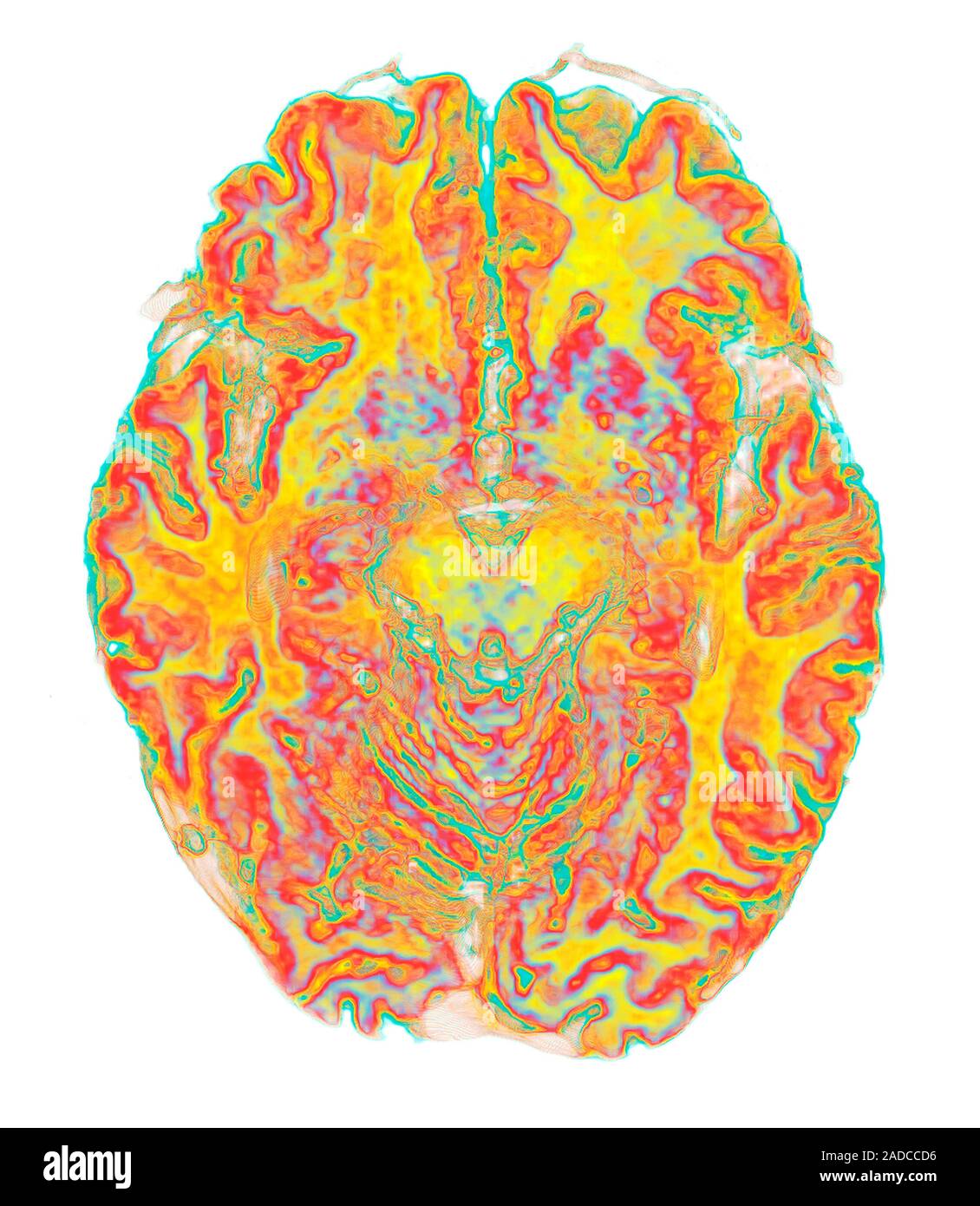 Human brain, coloured 3D magnetic resonance imaging (MRI) scan. This is the basal region of the ...