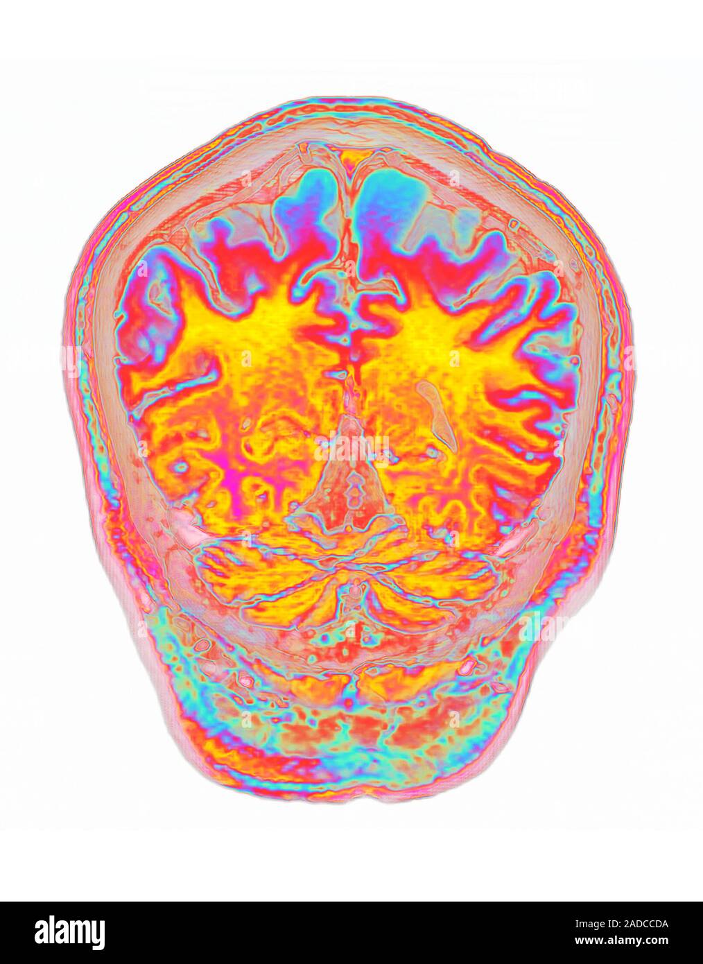 Human head and brain, coloured 3D magnetic resonance imaging (MRI) scan. This coronal view shows ...
