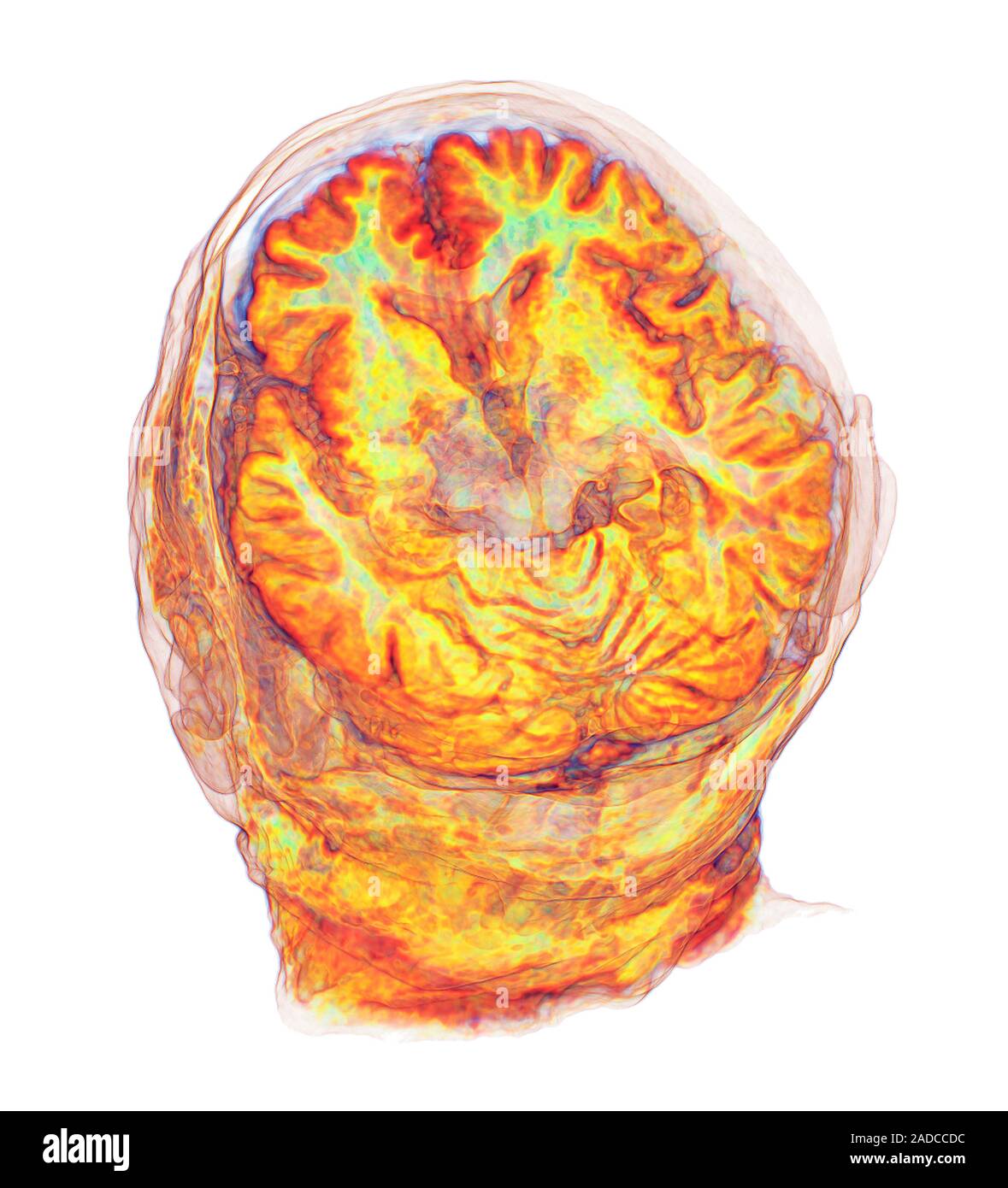 Brain in white matter disease, coloured 3D magnetic resonance imaging ...
