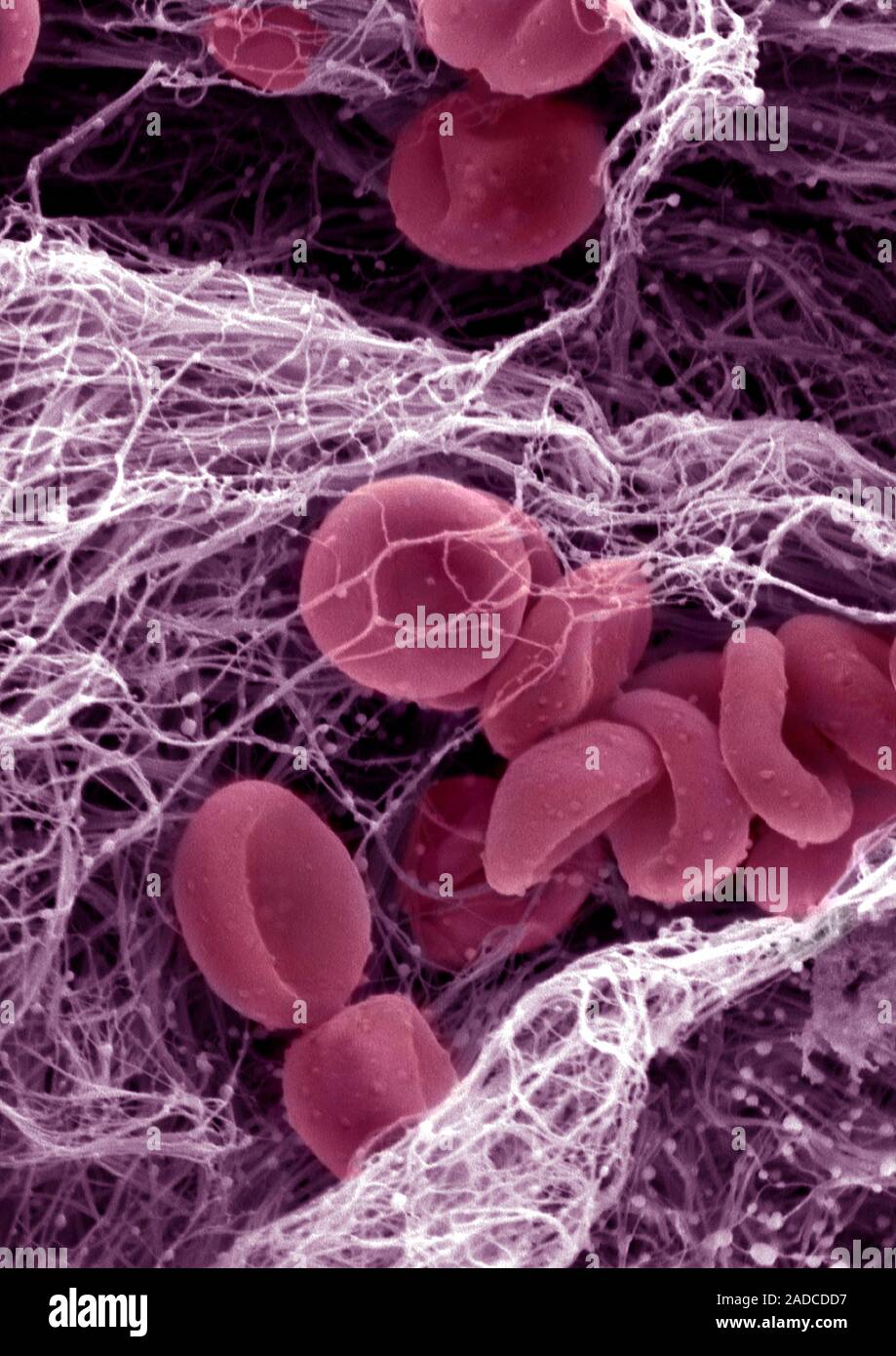 Blood clot. Coloured scanning electron micrograph (SEM) of red blood ...