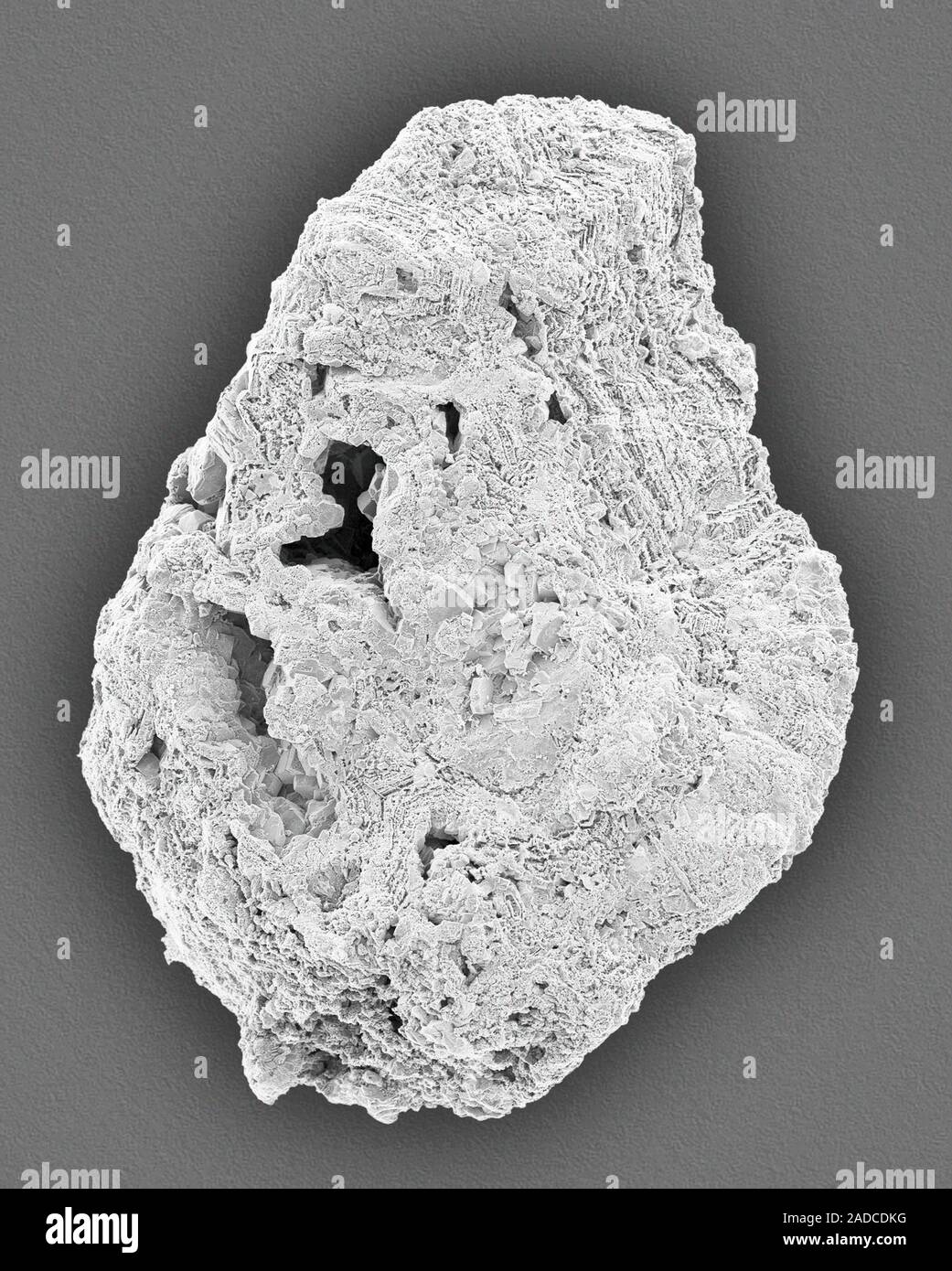 Kidney stone, scanning electron micrograph (SEM). Kidney stones are ...