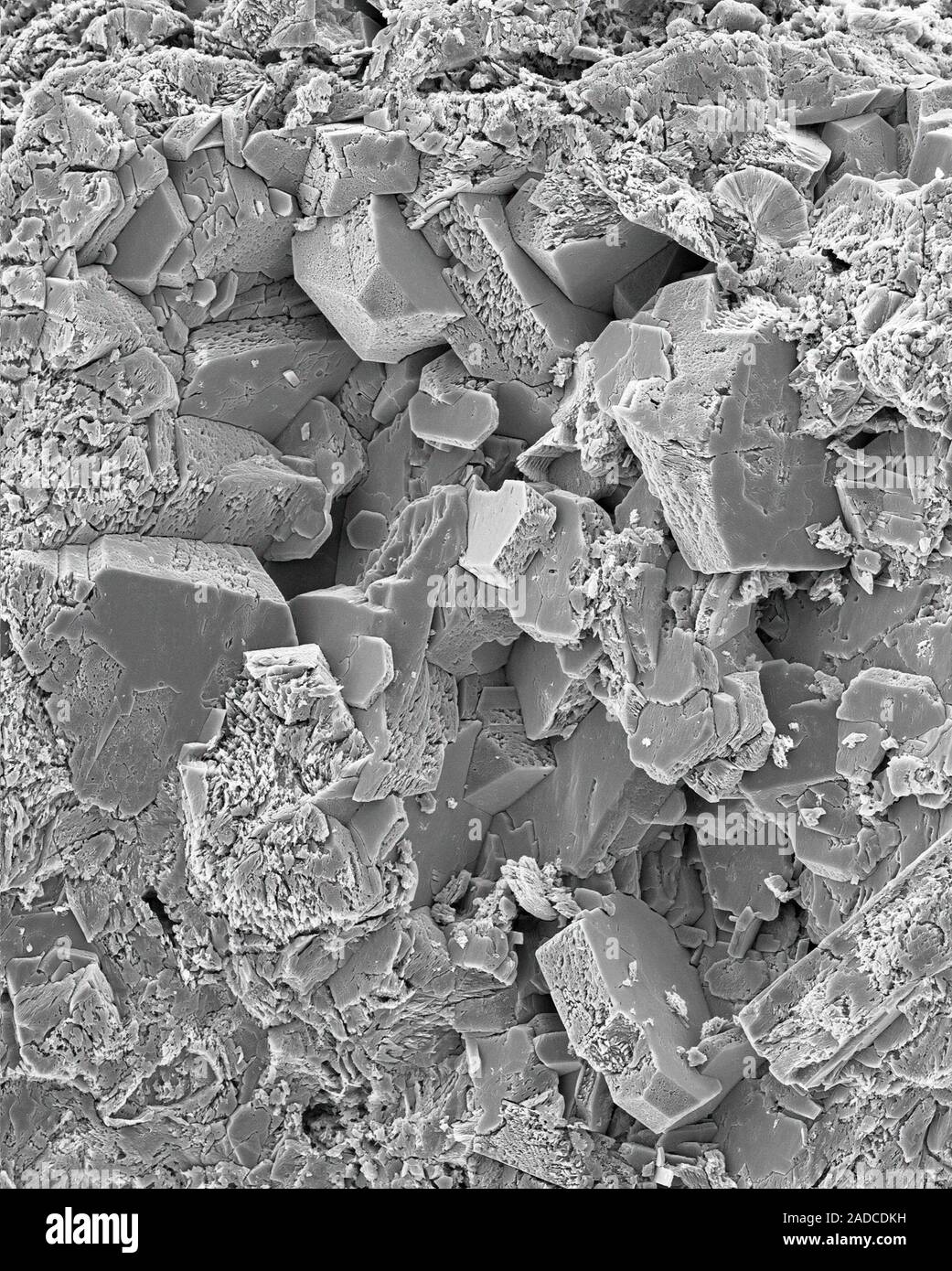 Kidney stone, scanning electron micrograph (SEM). Kidney stones are ...