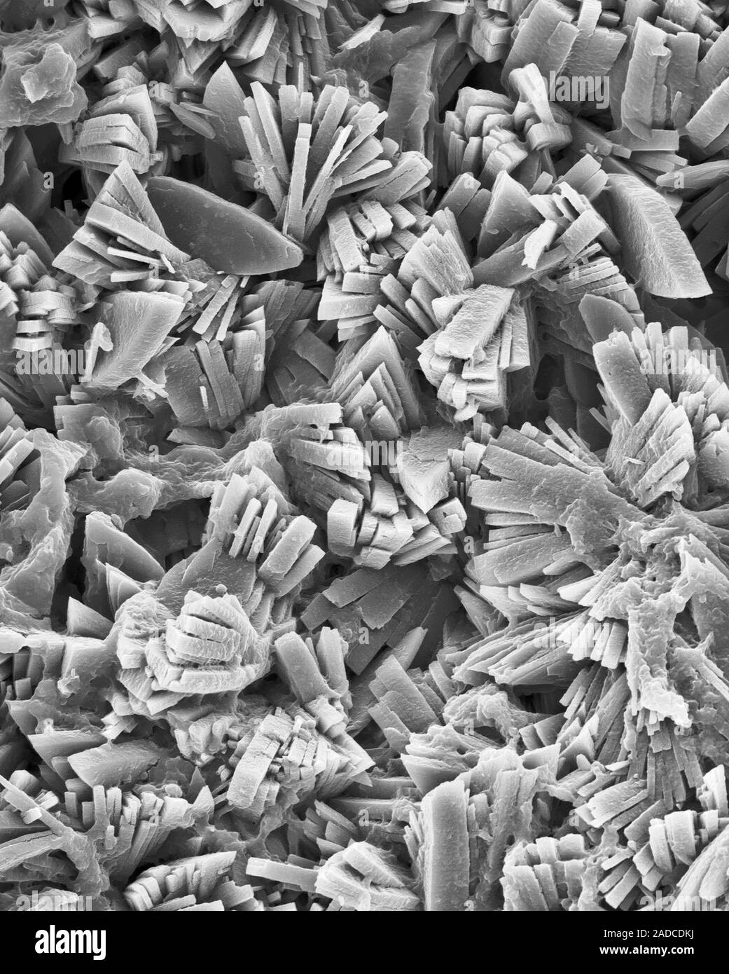 Kidney stone, scanning electron micrograph (SEM). Kidney stones are ...