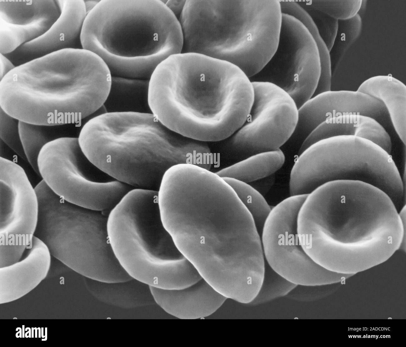 Sickle blood cell (oblong, tapered cell) among healthy red blood cells ...