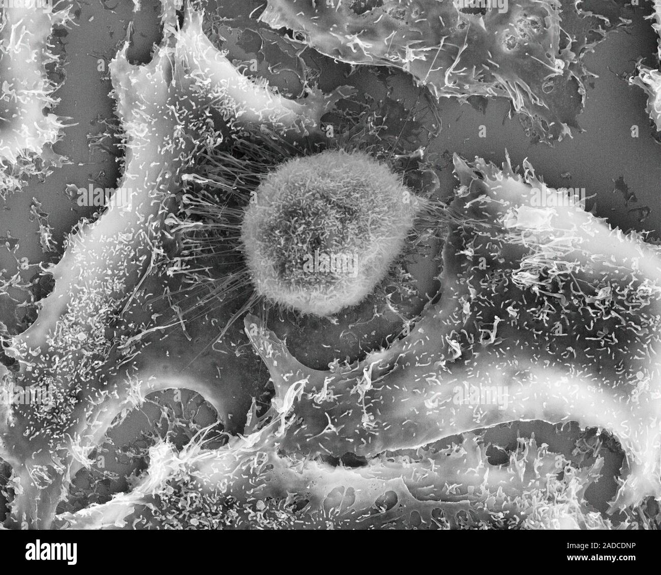 Human lung epithelial cancer cell among healthy epithelial cells ...