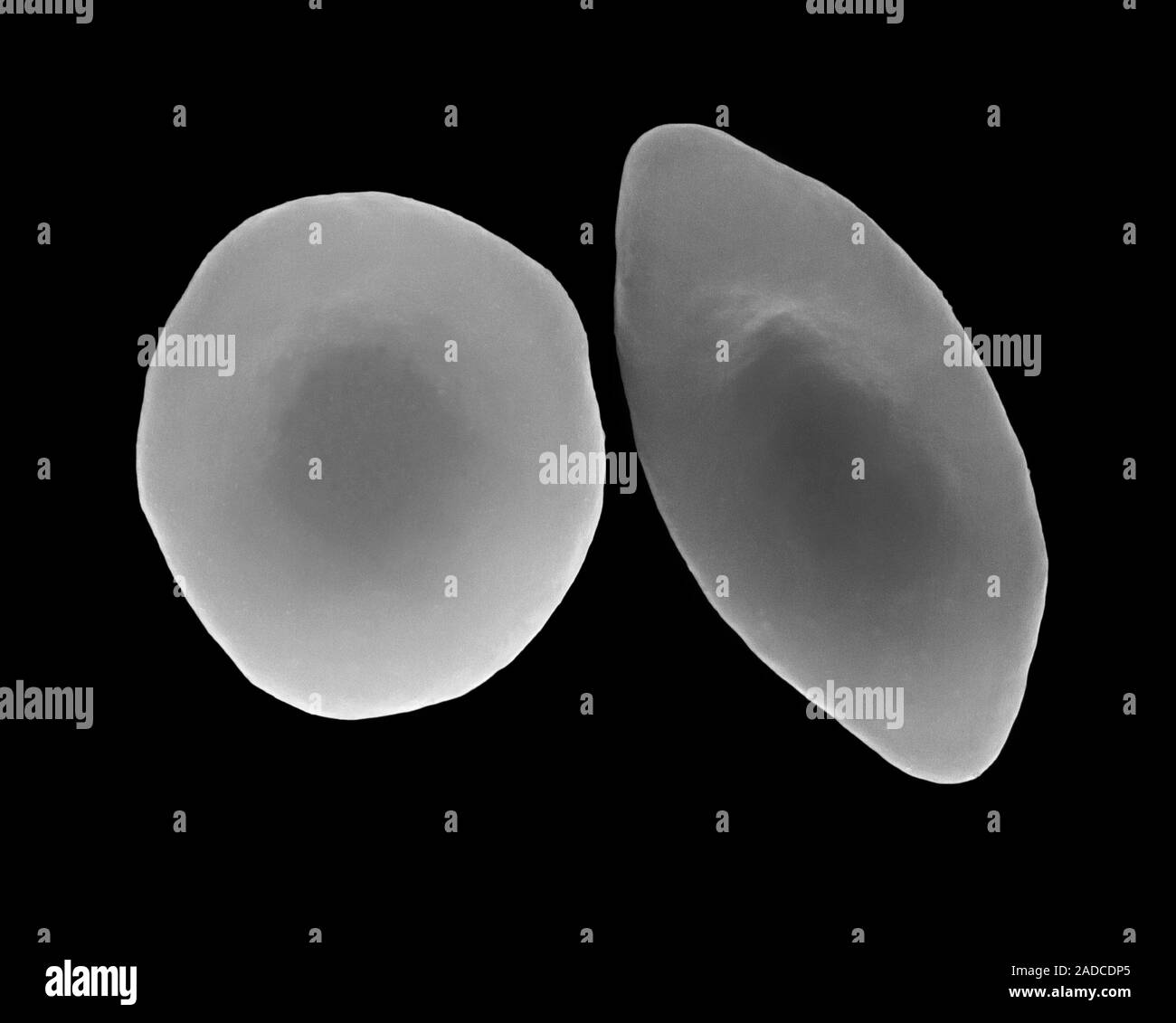 Sickle red blood cell (oblong, tapered cell) and healthy red blood cell ...