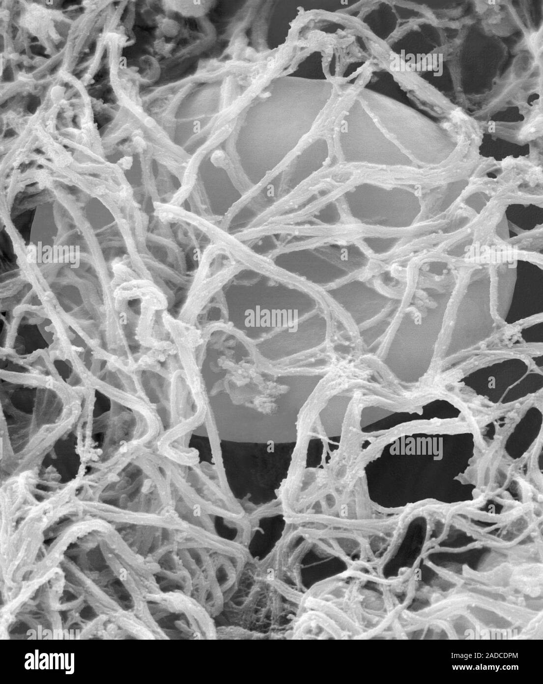 Human red blood cells trapped in a fibrin blood clot, scanning electron ...