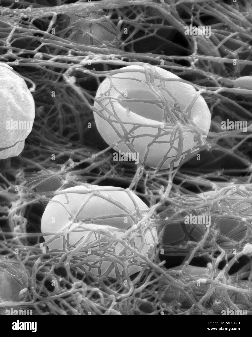 Human red blood cells trapped in a fibrin blood clot, scanning electron ...