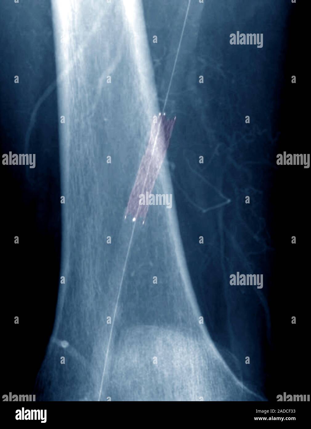 Leg artery angioplasty. X-ray of the right superficial femoral artery ...