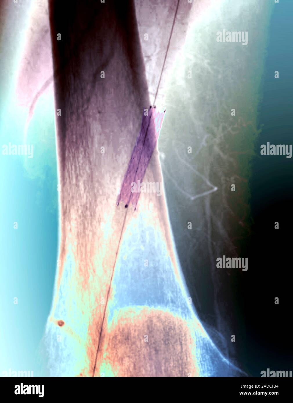 Leg artery angioplasty. Coloured X-ray of the right superficial femoral ...