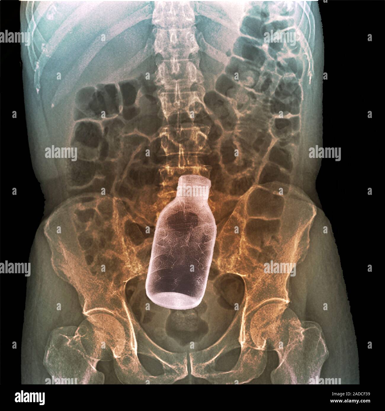 Bottle in rectum. Coloured emergency X-ray of the abdomen of a 40-year-old man, showing a bottle ...