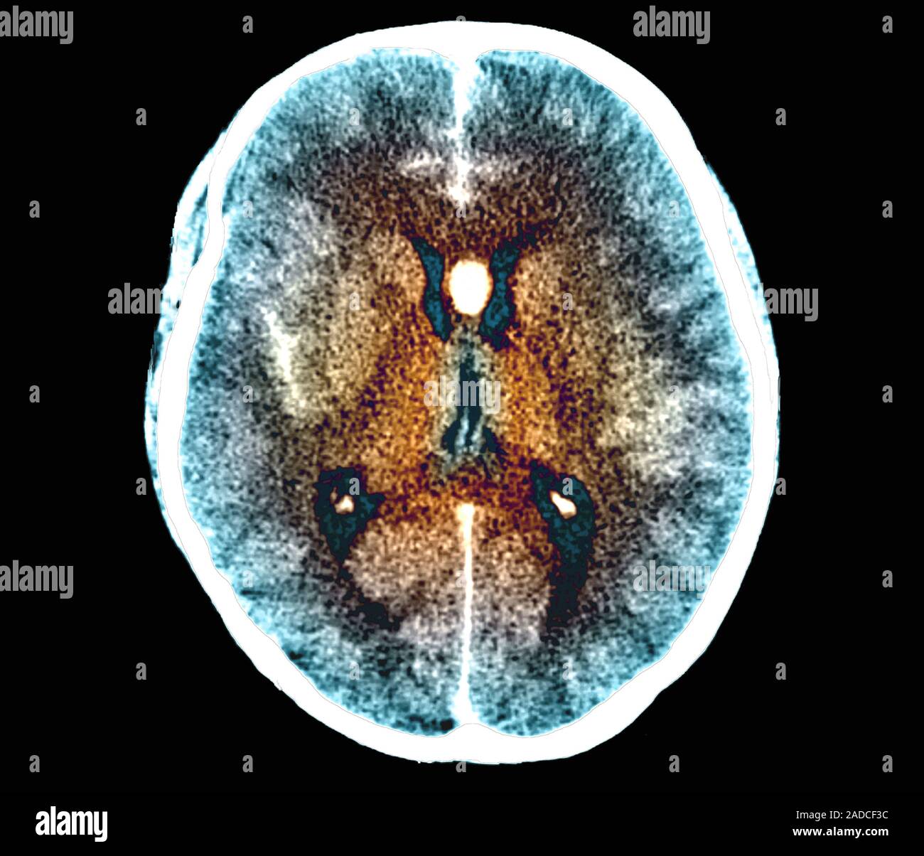 Brain haemorrhage. Coloured axial computed tomography (CT) scan through the brain of a 28-year ...