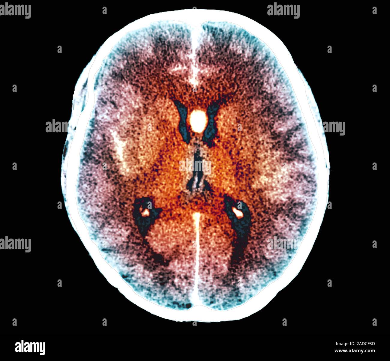 Brain haemorrhage. Coloured axial computed tomography (CT) scan through the brain of a 28-year ...