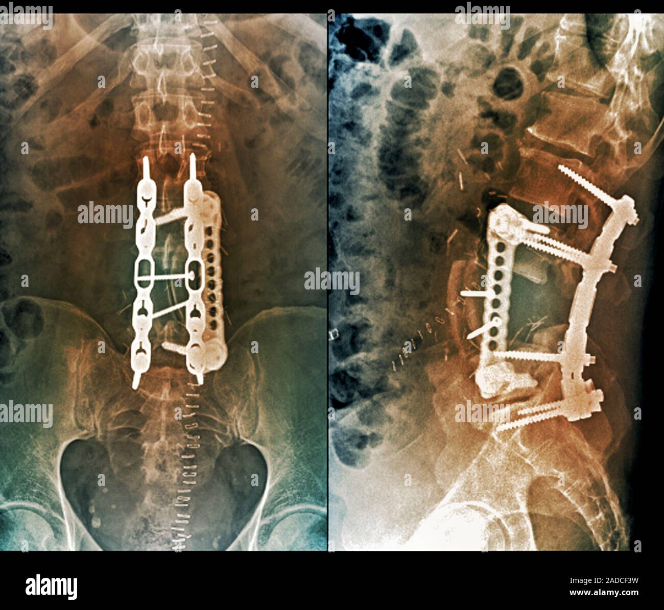 Implants following spinal surgery. Coloured frontal (left) and lateral ...