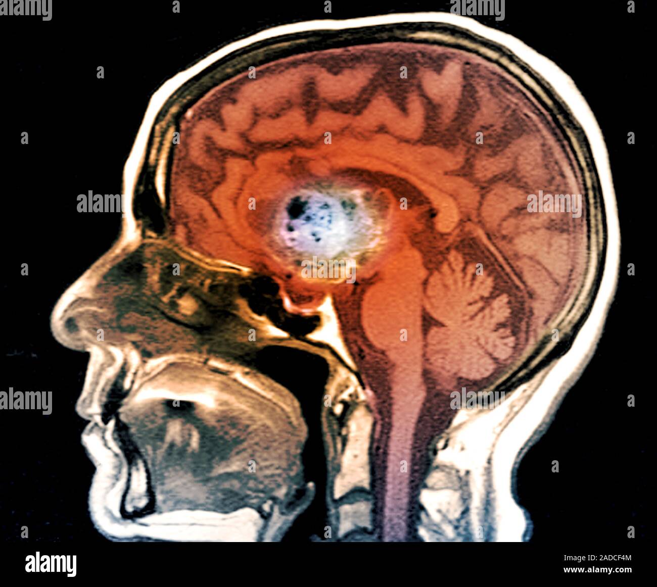 Astrocytoma brain cancer. Coloured median sagittal magnetic resonance ...