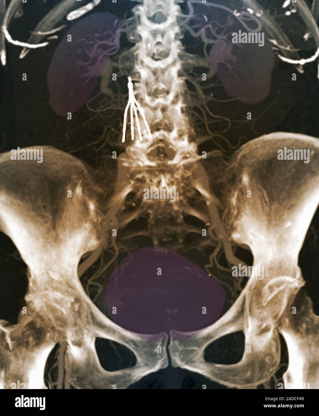 IVC filter implanted in abdomen. Coloured combined 2D computed ...