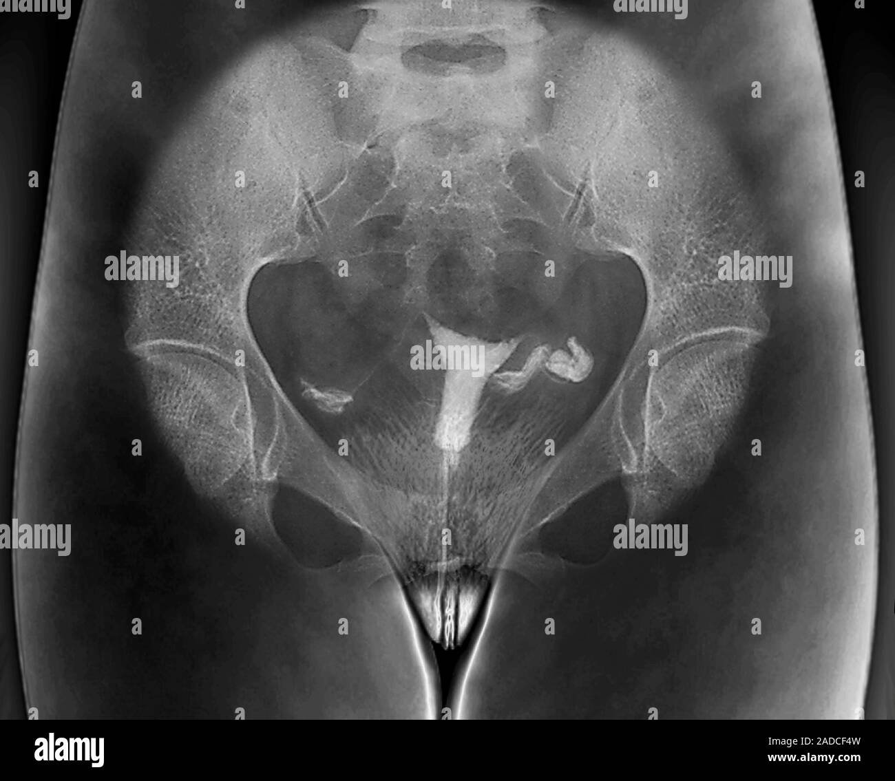Female infertility. Hystero-salpingogram (contrast medium X-ray of the ...