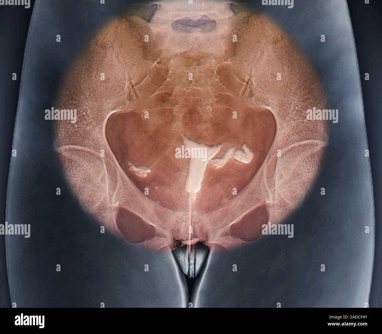 Female infertility. Coloured hystero-salpingogram (contrast medium X ...