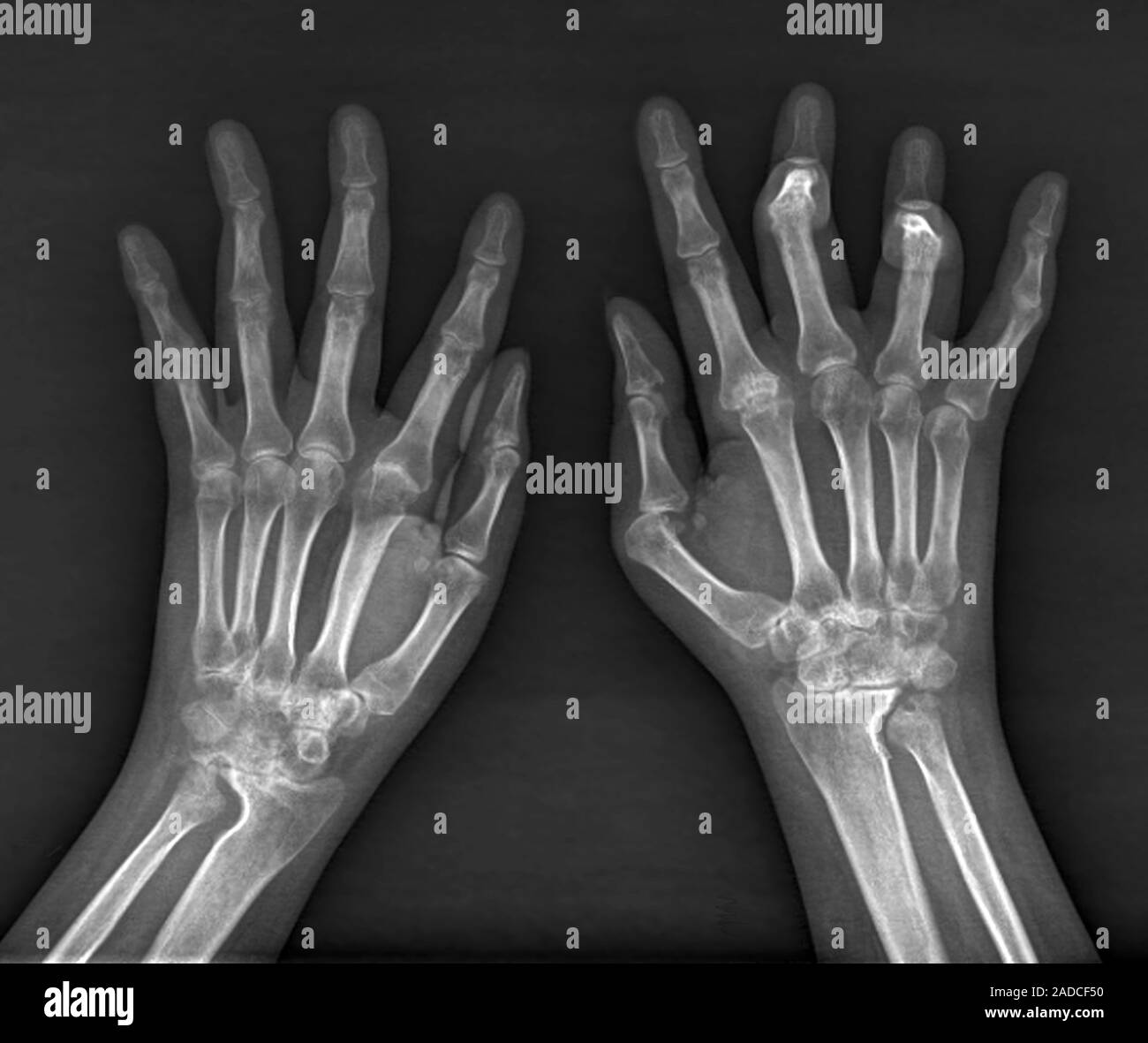 Rheumatoid Arthritis Of The Hands Bilateral X Rays Of The Hands And Wrists Of A 37 Year Old