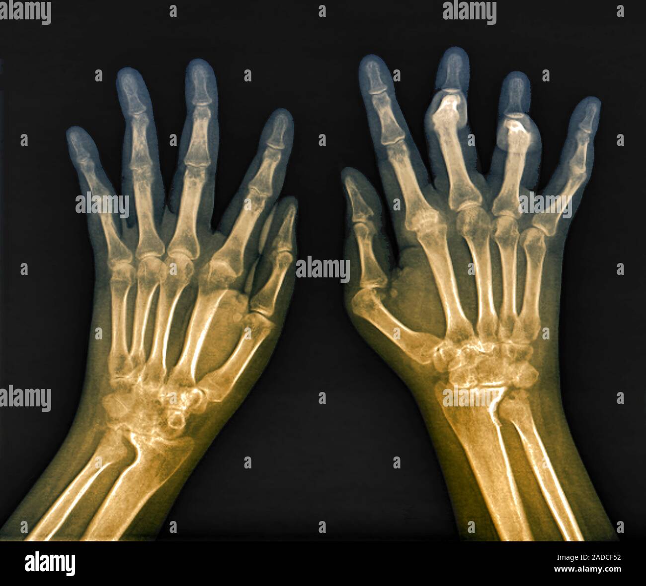 Rheumatoid Arthritis Hand X Ray