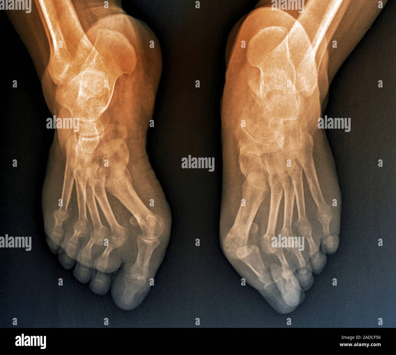 Rheumatoid arthritis of the feet. Coloured bilateral X-rays of the feet ...