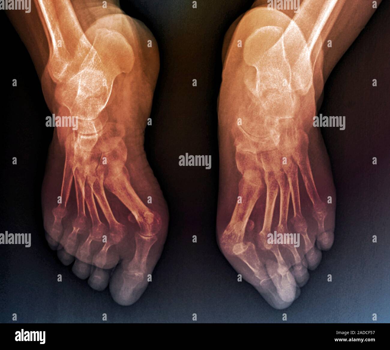 Rheumatoid arthritis of the feet. Coloured bilateral X-rays of the feet ...