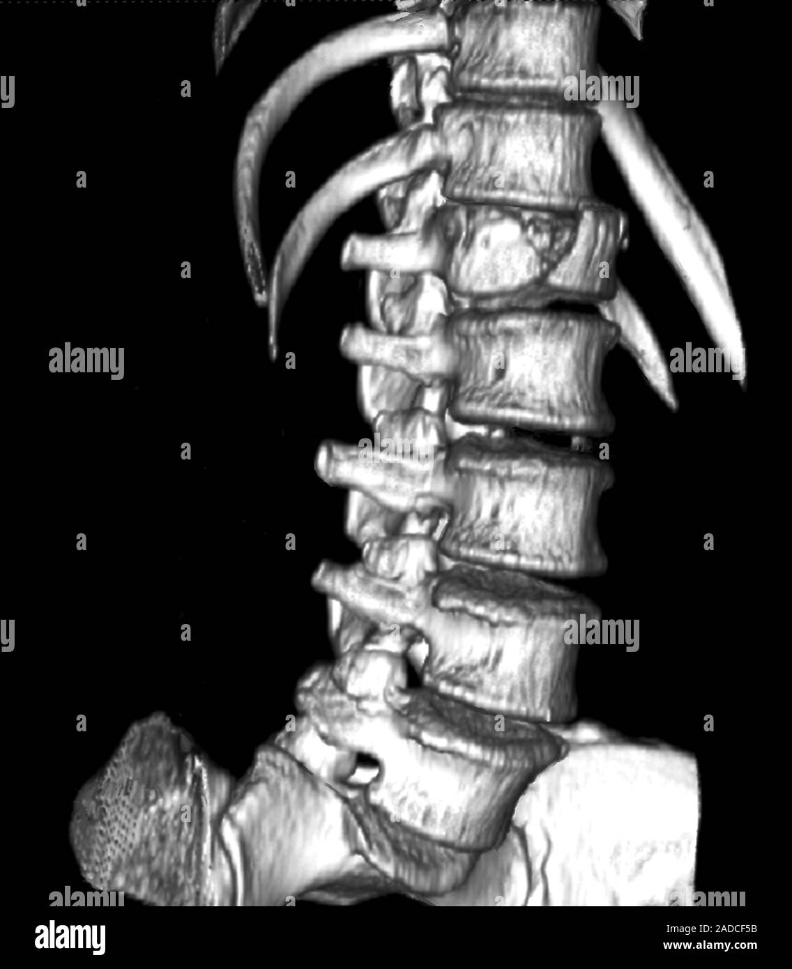 Spinal injury. 3D computed tomography (CT) scan of the lumbar (lower ...