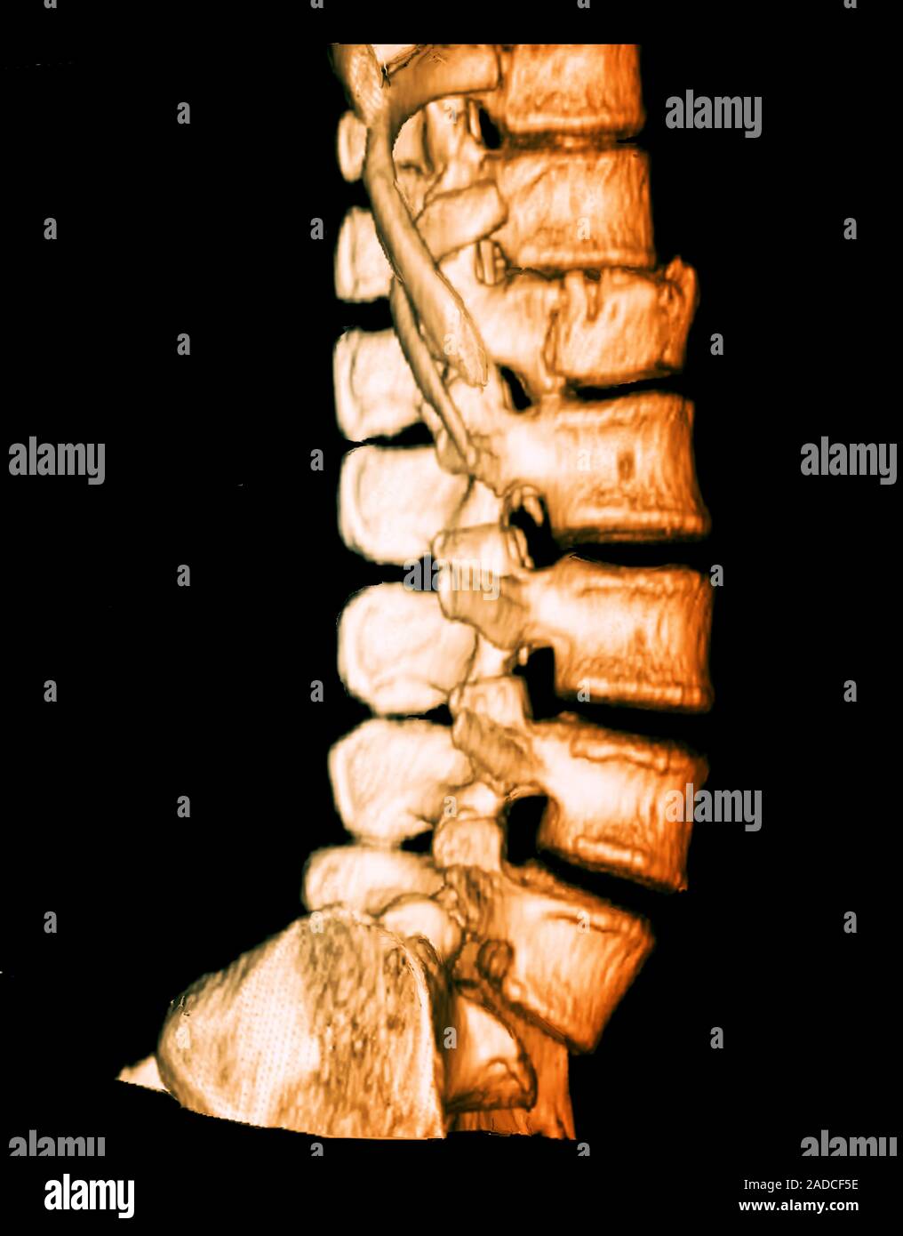 Spinal injury. Coloured 3D computed tomography (CT) scan of the lumbar (lower) spine of a 57 ...