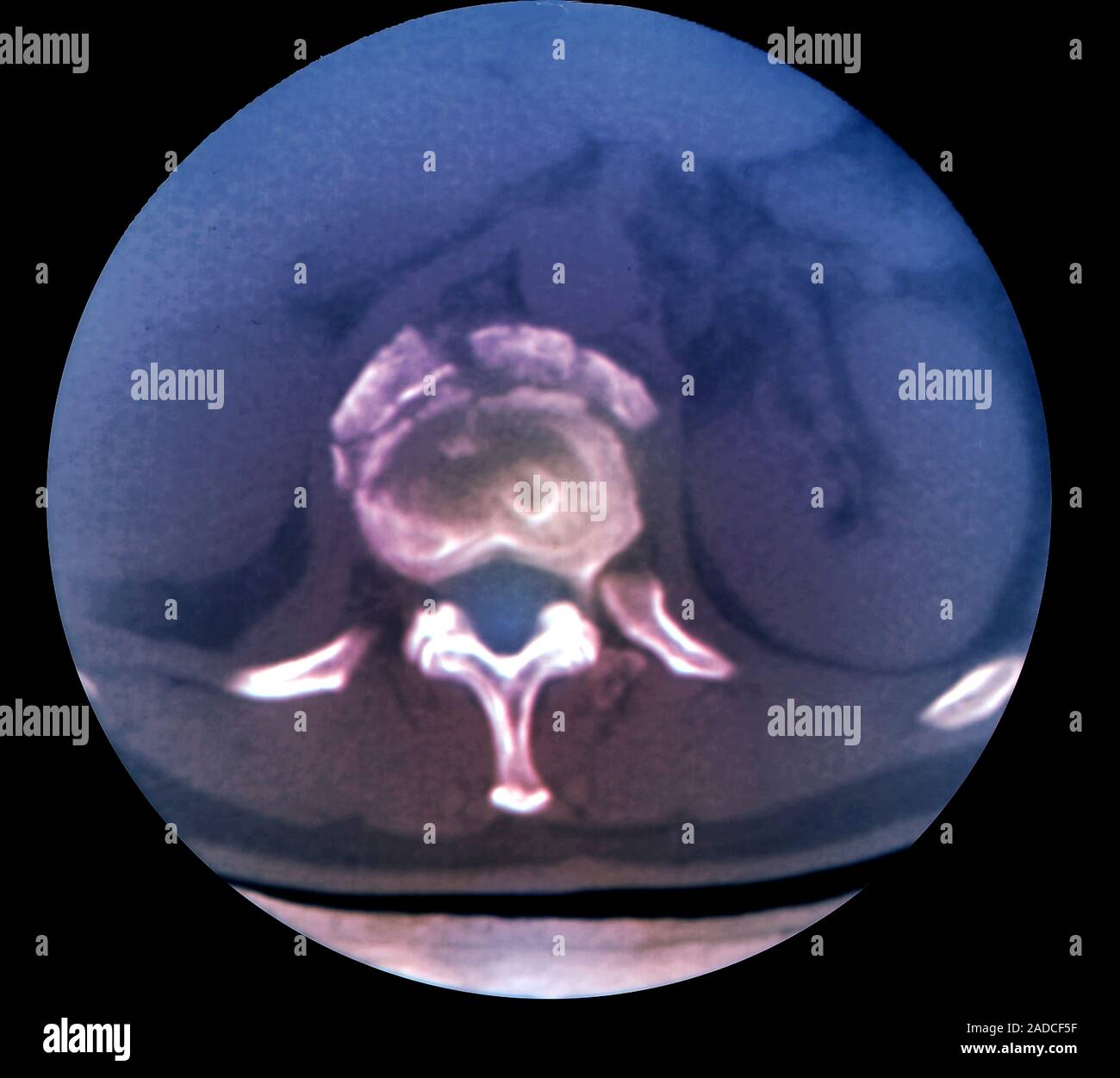 Spine fracture bone fragments. Coloured axial computed tomography (CT ...