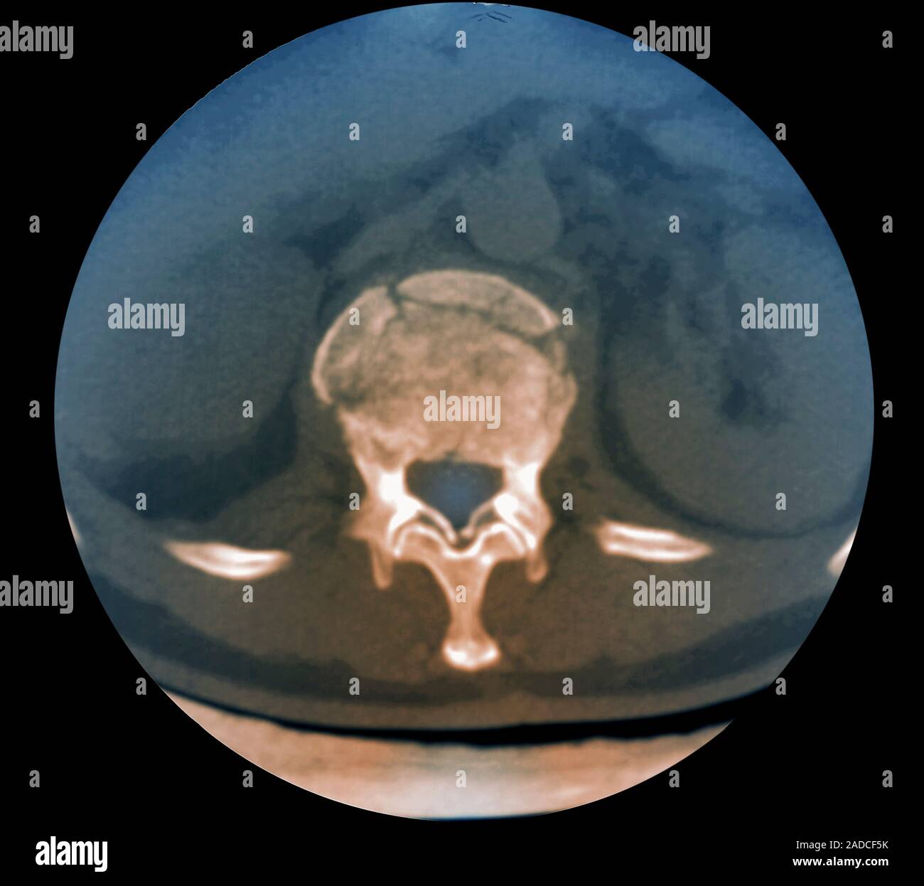 Fractured spine vertebra. Coloured axial computed tomography (CT) scan ...
