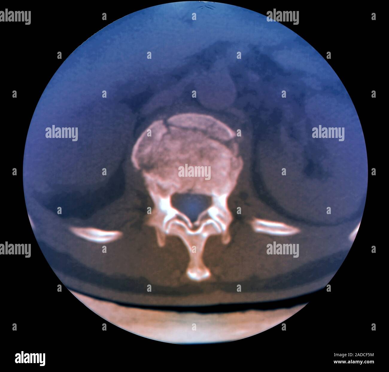 Fractured spine vertebra. Coloured axial computed tomography (CT) scan ...